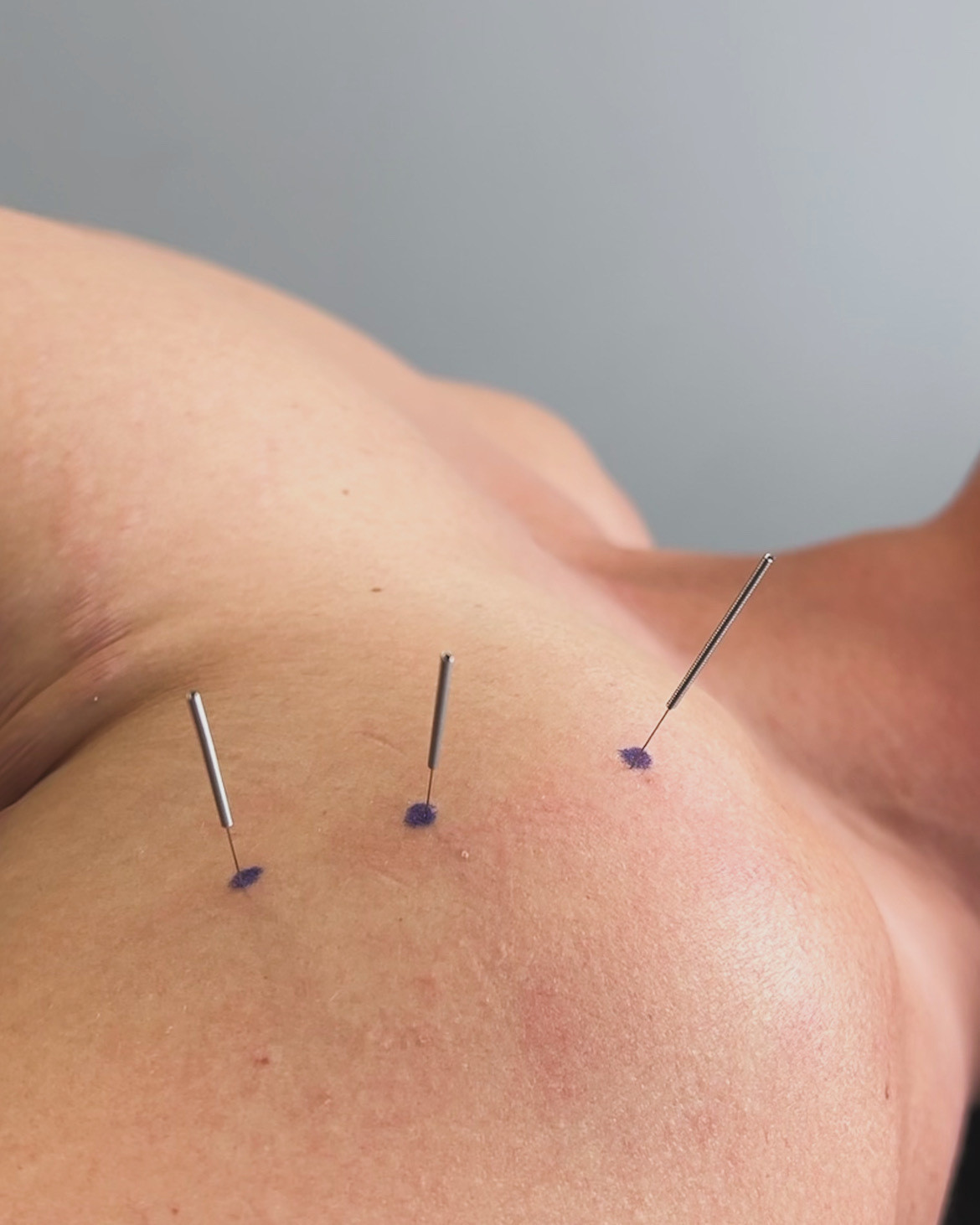 Dry Needling vs. Acupuncture: What’s the Difference—and Which One Is Right for You? | Fortify ...